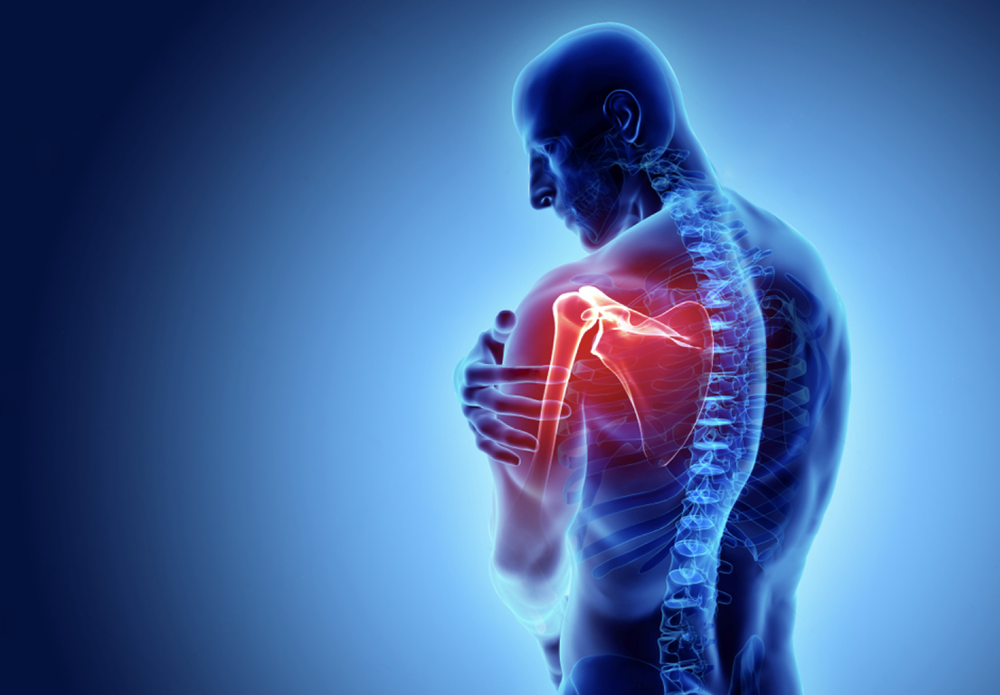 Qué es el hombro congelado o capsulitis adhesiva | Clínica DKF