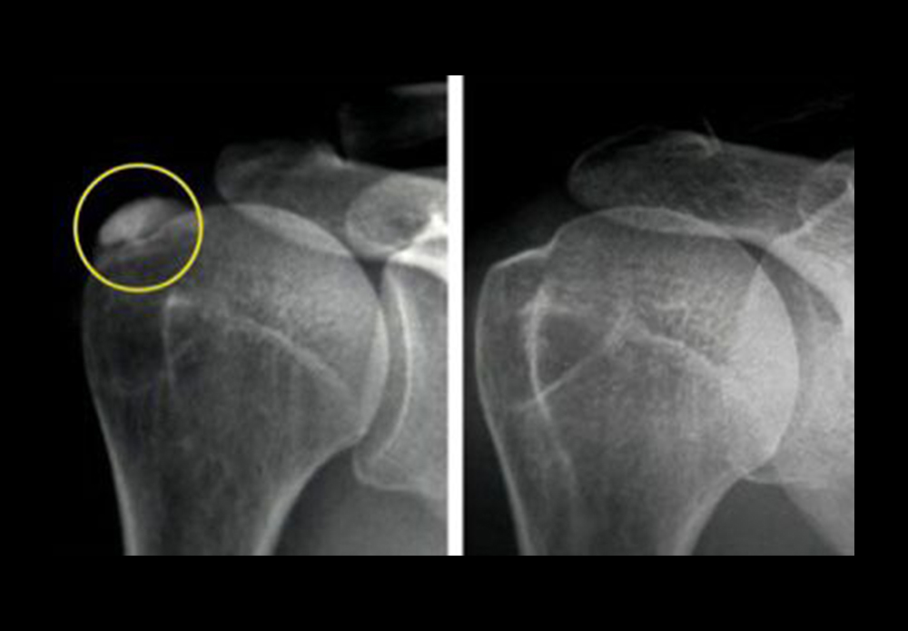 Tendinopatía calcificante de hombro | Clínica DKF