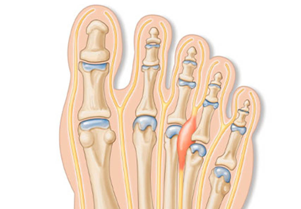 Neuroma de Morton: qué es y cómo se trata - Clínica DKF